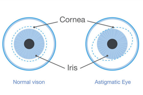 Astigmatism vs. Normal Vision: A Detailed Look at Key Differences